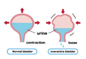 The Difference Between UTI and OAB? | understandingutis.com